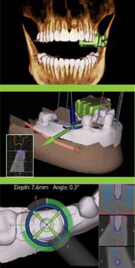 Dynamic Implant Navigation X-Guide Medina OH | X-Guide Cleveland